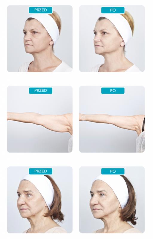 Zaffiro, Bezoperacyjny lifting twarzy, szyi, Usuwanie zmarszczek bez ...